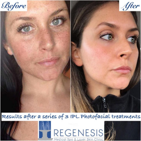 IPL Photofacials in New Orleans - Regenesis Medical Spa & Laser Skin Clinic