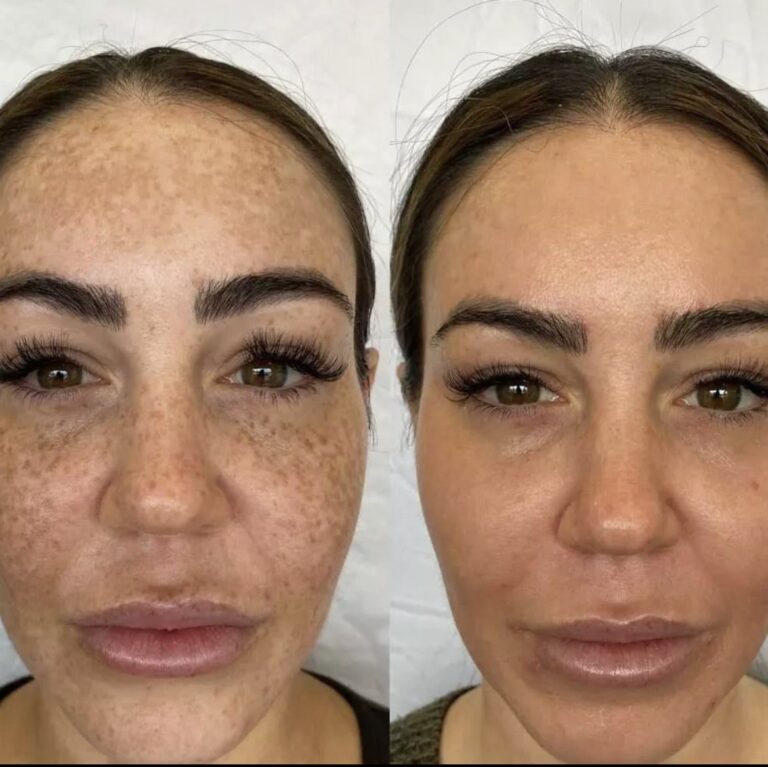 Cosmelan Peel in New Orleans - Regenesis Medical Spa & Laser Skin Clinic