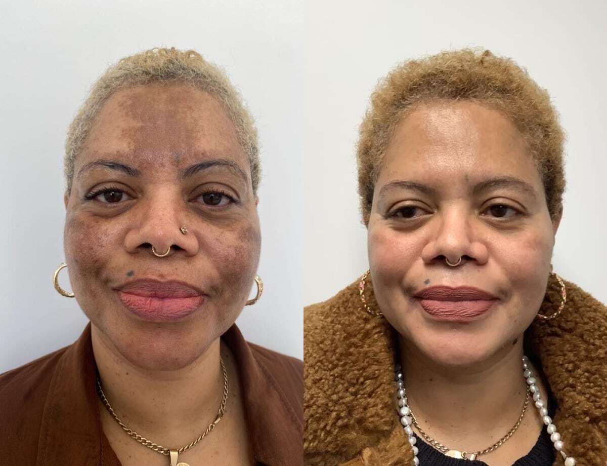 Cosmelan Peel in New Orleans - Regenesis Medical Spa & Laser Skin Clinic