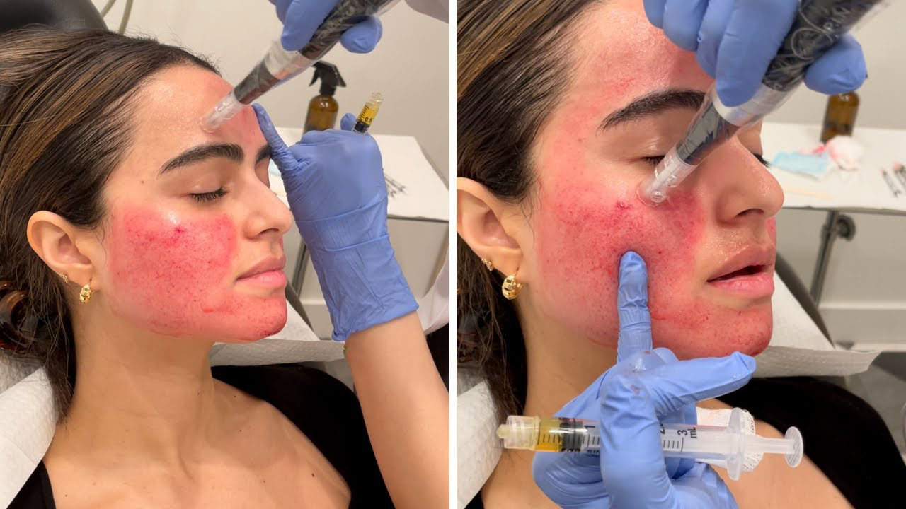 PRP therapy New Orleans - Regenesis Medical Spa & Laser Skin Clinic