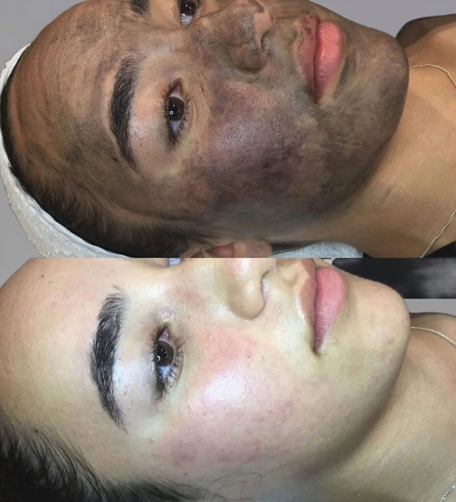Pico Laser Skin Treatment New Orleans, Carbon Laser Peel New Orleans