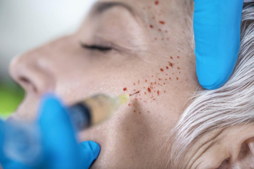 PRP therapy New Orleans - Regenesis Medical Spa & Laser Skin Clinic